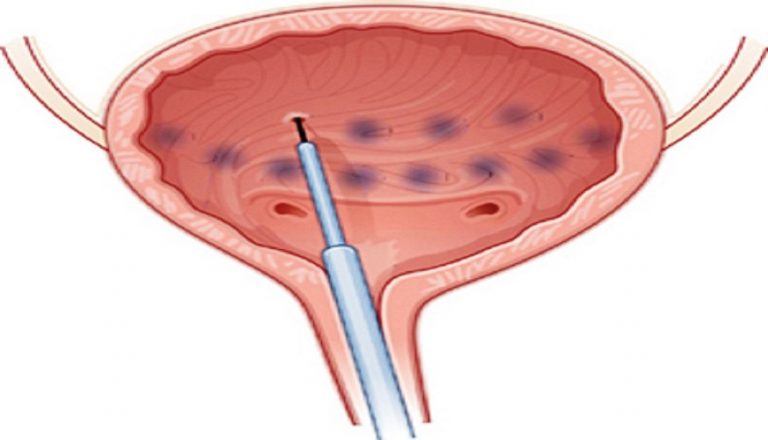 Botox for Urinary Incontinence – Optimal Health